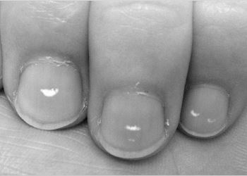 Tırnakta beyaz leke neden oluşur? – merakname